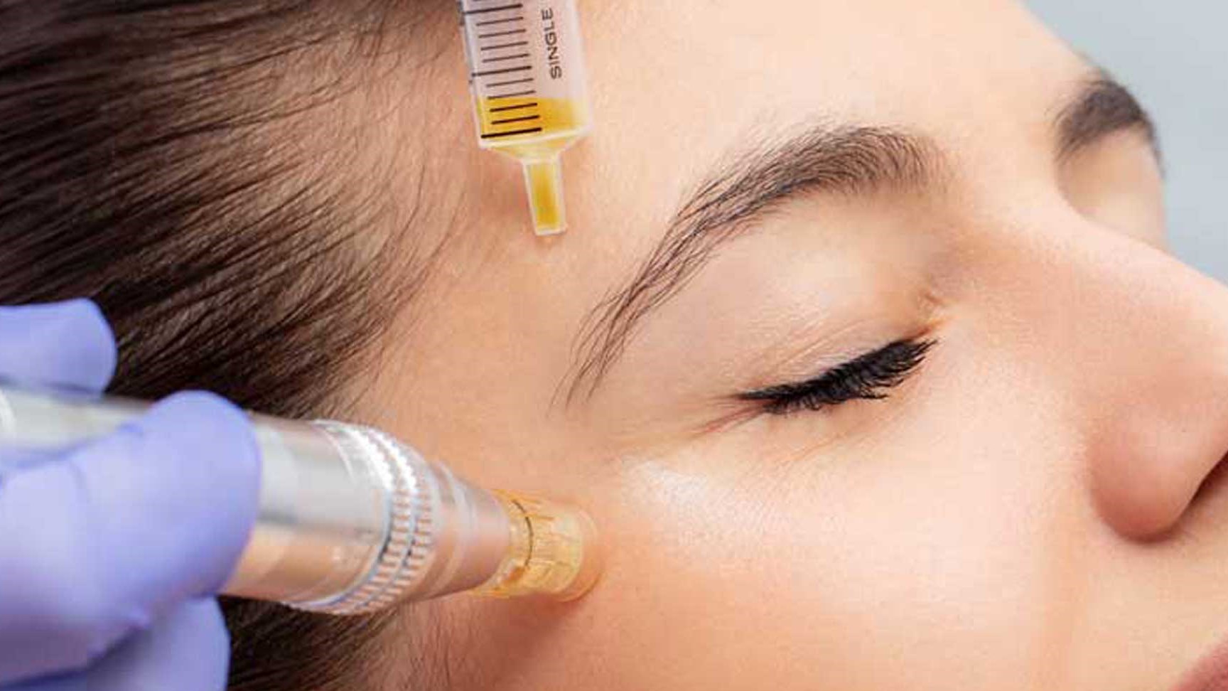 Unlock Radiant Skin with PRP Facials: The Natural Rejuvenation Treatment
